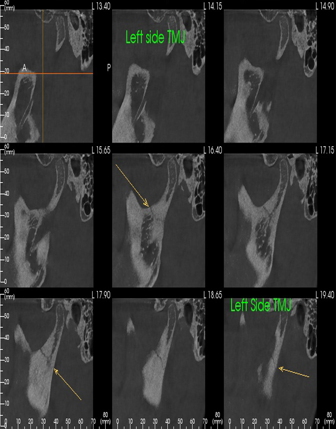 Tmj Fracture Nidaan Dental